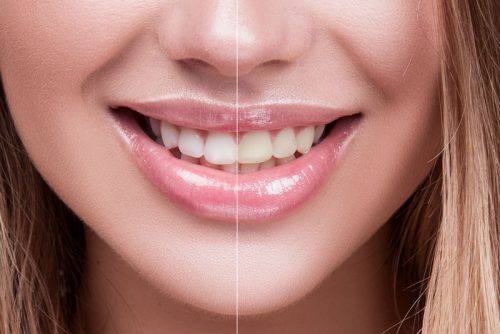 Understanding the Different Types of Smile Stages | Chapnick Dental